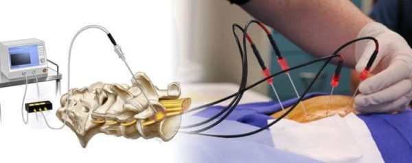 Radio Frequency(RF) Thermal Ablation - Best spine specialist doctor in Surat - Dr.shishir mehta